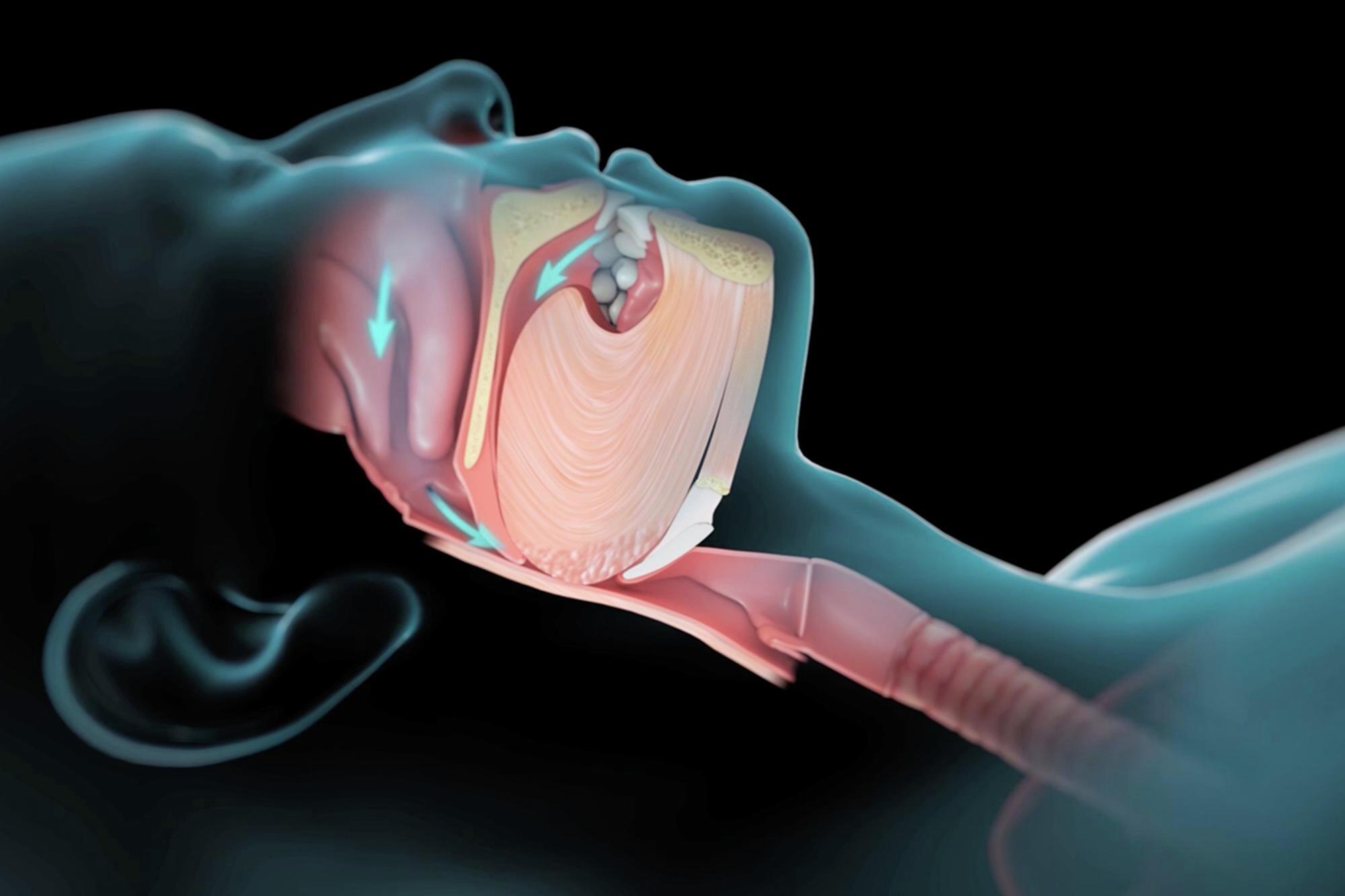 Obstructive Sleep Apnea Treated by Top Baltimore Sleep Medicine Doctors ...