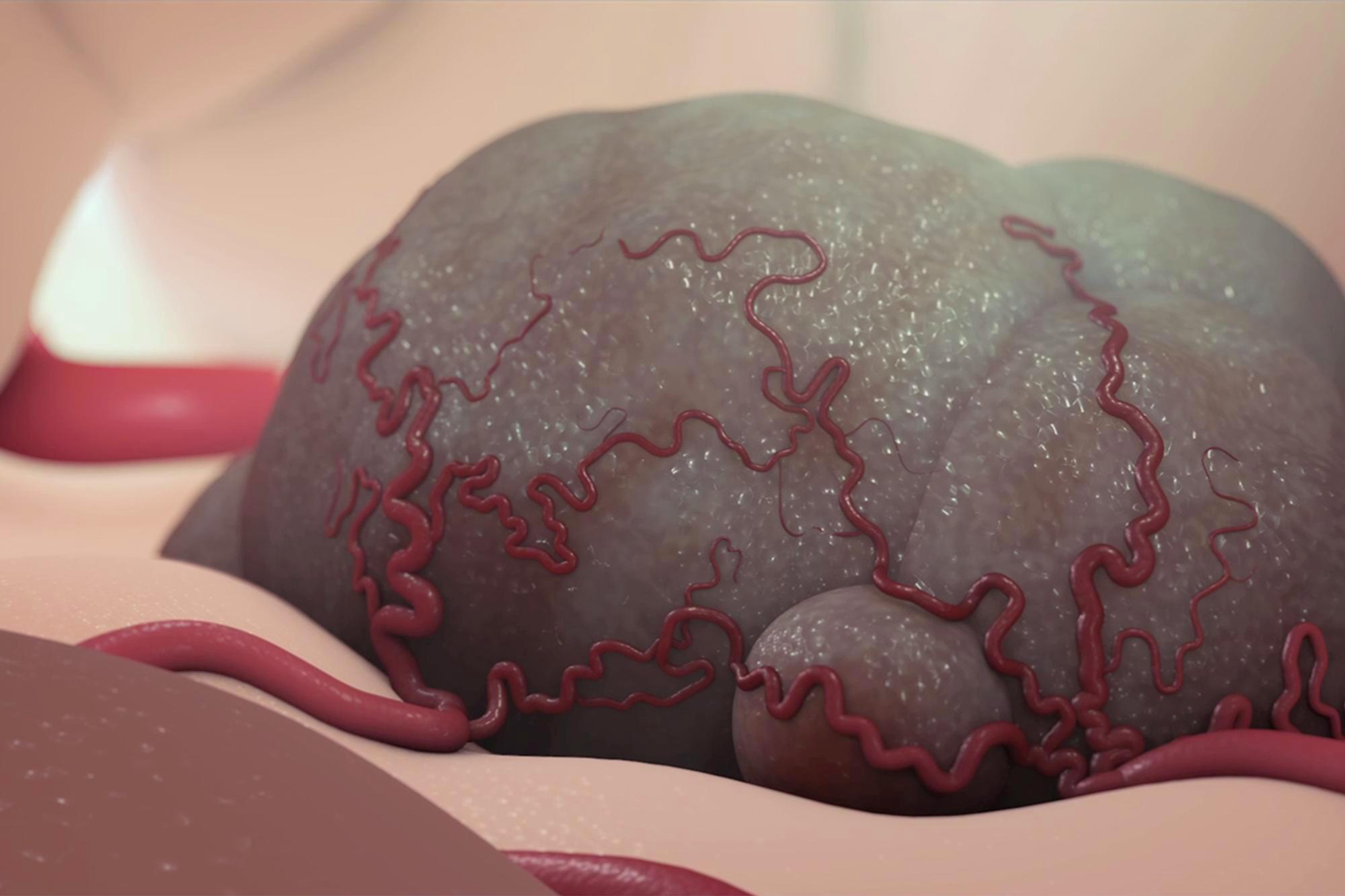 Ovarian Fallopian Tube And Primary Peritoneal Cancers Mercy